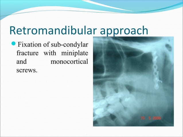 surgical approaches to the mandibular condyle | PPT