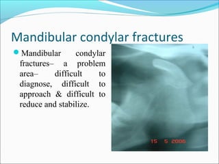 surgical approaches to the mandibular condyle | PPT