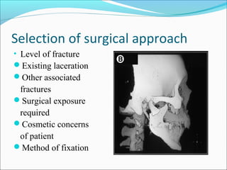 surgical approaches to the mandibular condyle | PPT