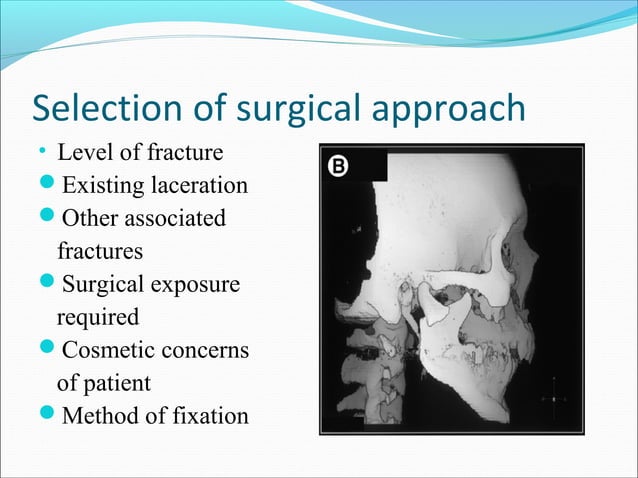 surgical approaches to the mandibular condyle | PPT | Free Download