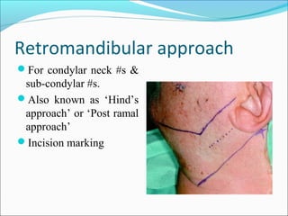 surgical approaches to the mandibular condyle | PPT