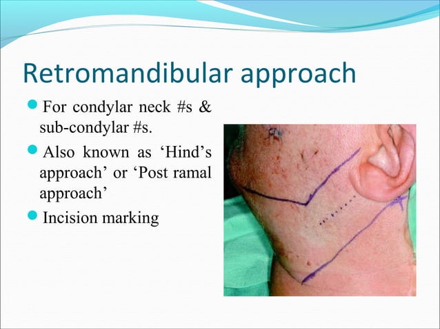 surgical approaches to the mandibular condyle | PPT