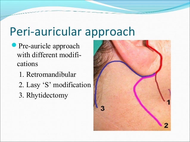 surgical approaches to the mandibular condyle
