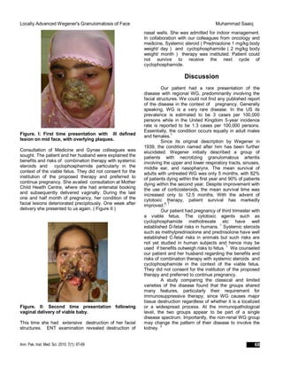 Wegeners granulomatosis of Face | PDF