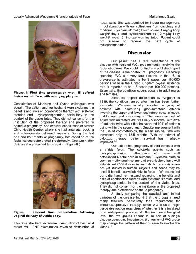 Wegeners granulomatosis of Face | PDF