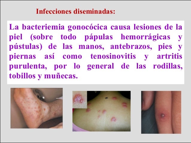 100. pw neisseria-2016_uc