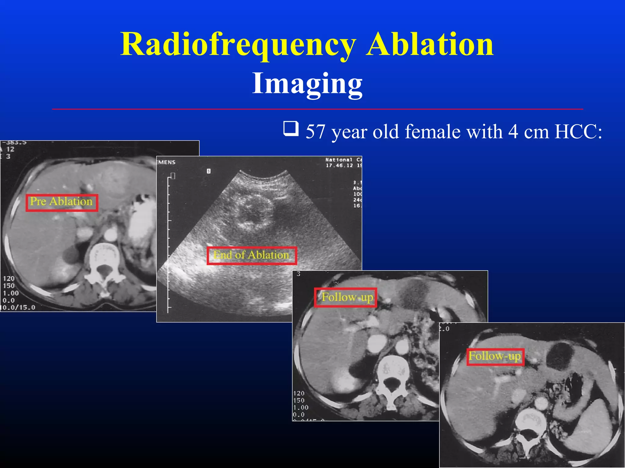 Ablation of HCC | PPT