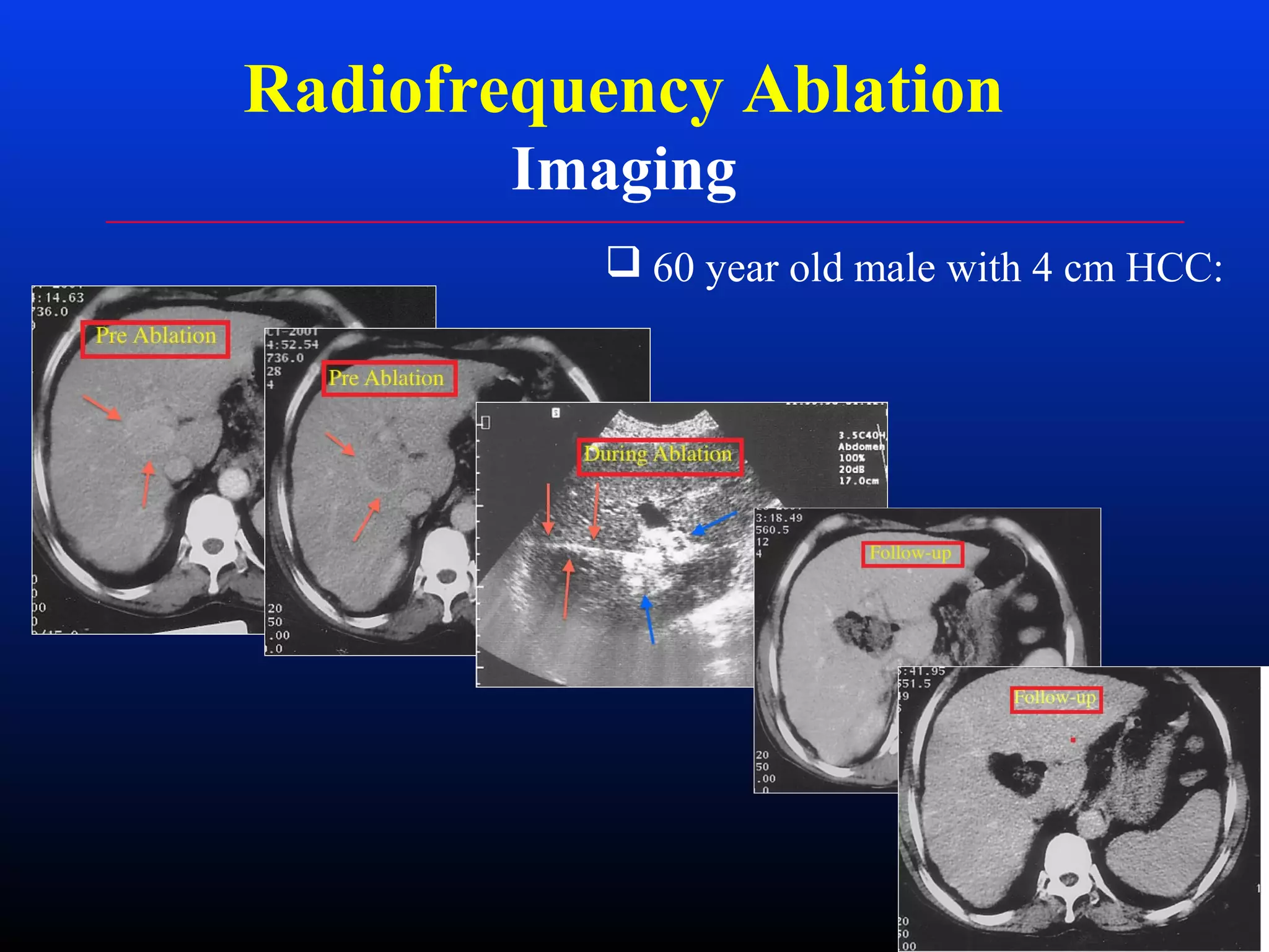Ablation of HCC | PPT