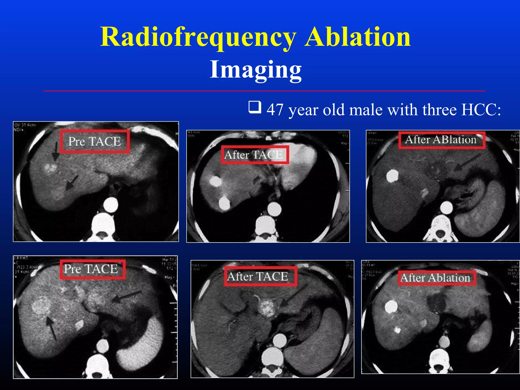 Ablation of HCC | PPT