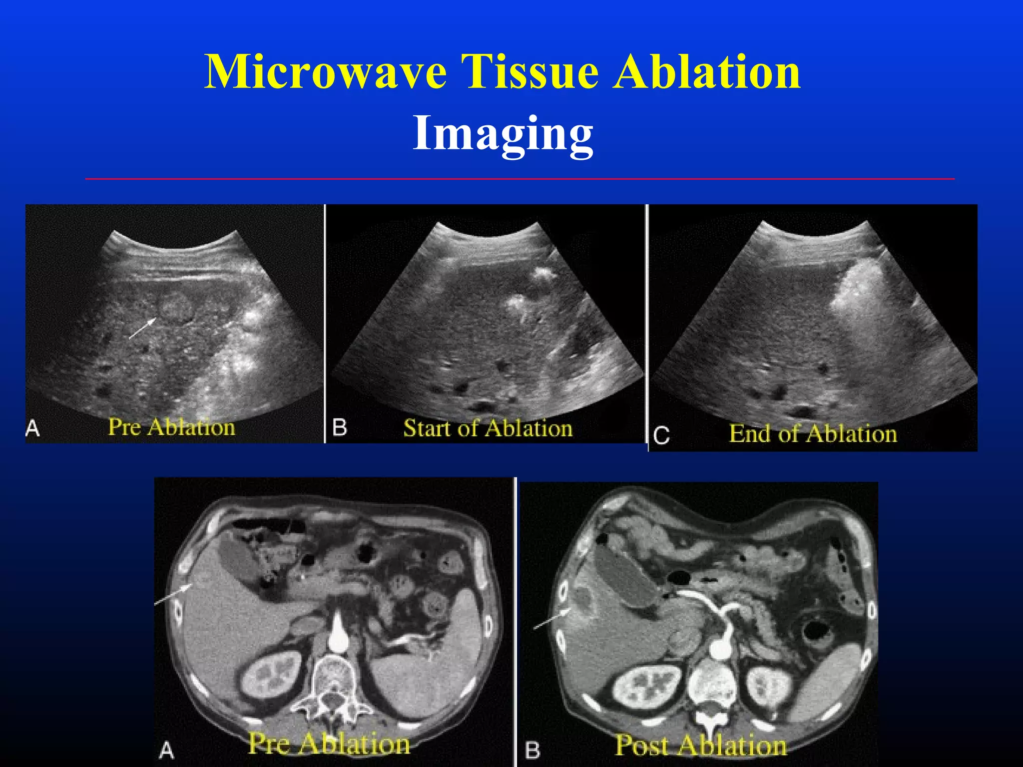 Ablation of HCC | PPT