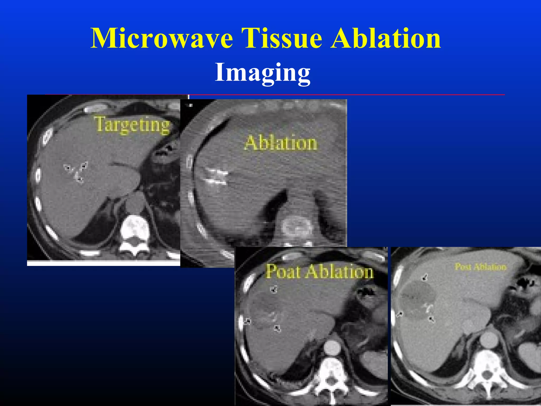 Ablation of HCC | PPT
