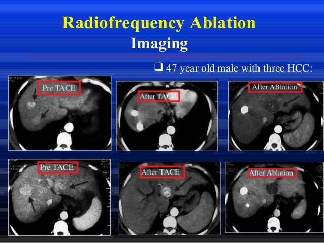 Ablation of HCC