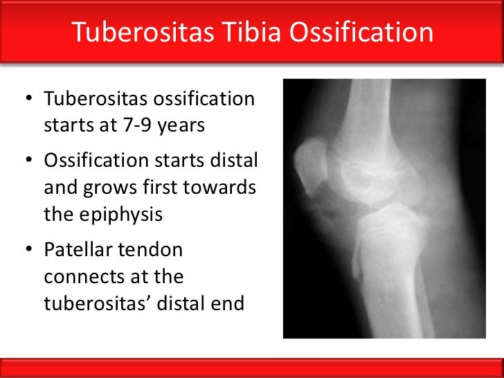 Osgood-Schlatter-Syndrome
