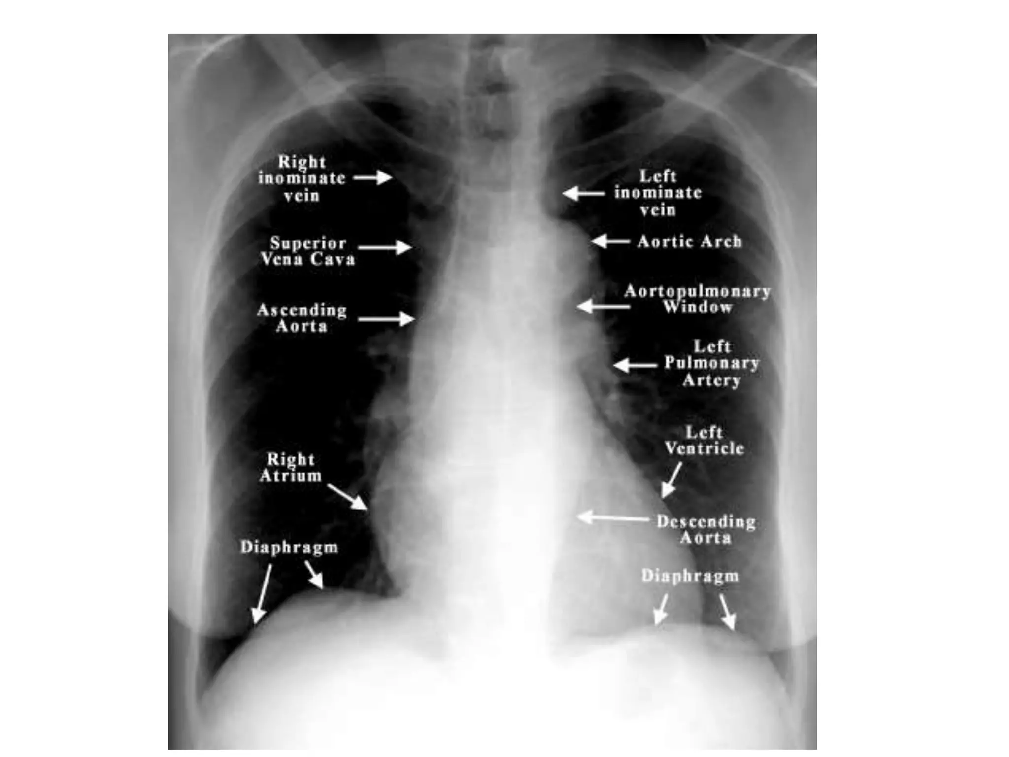Chest x-ray interpretation.ppt