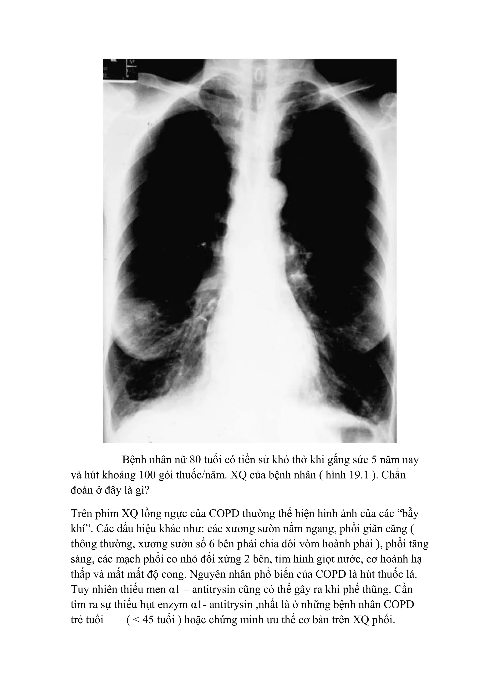 X-QUANG | 100 Case chest X rays | Chuyển ngữ tiếng Việt | PDF