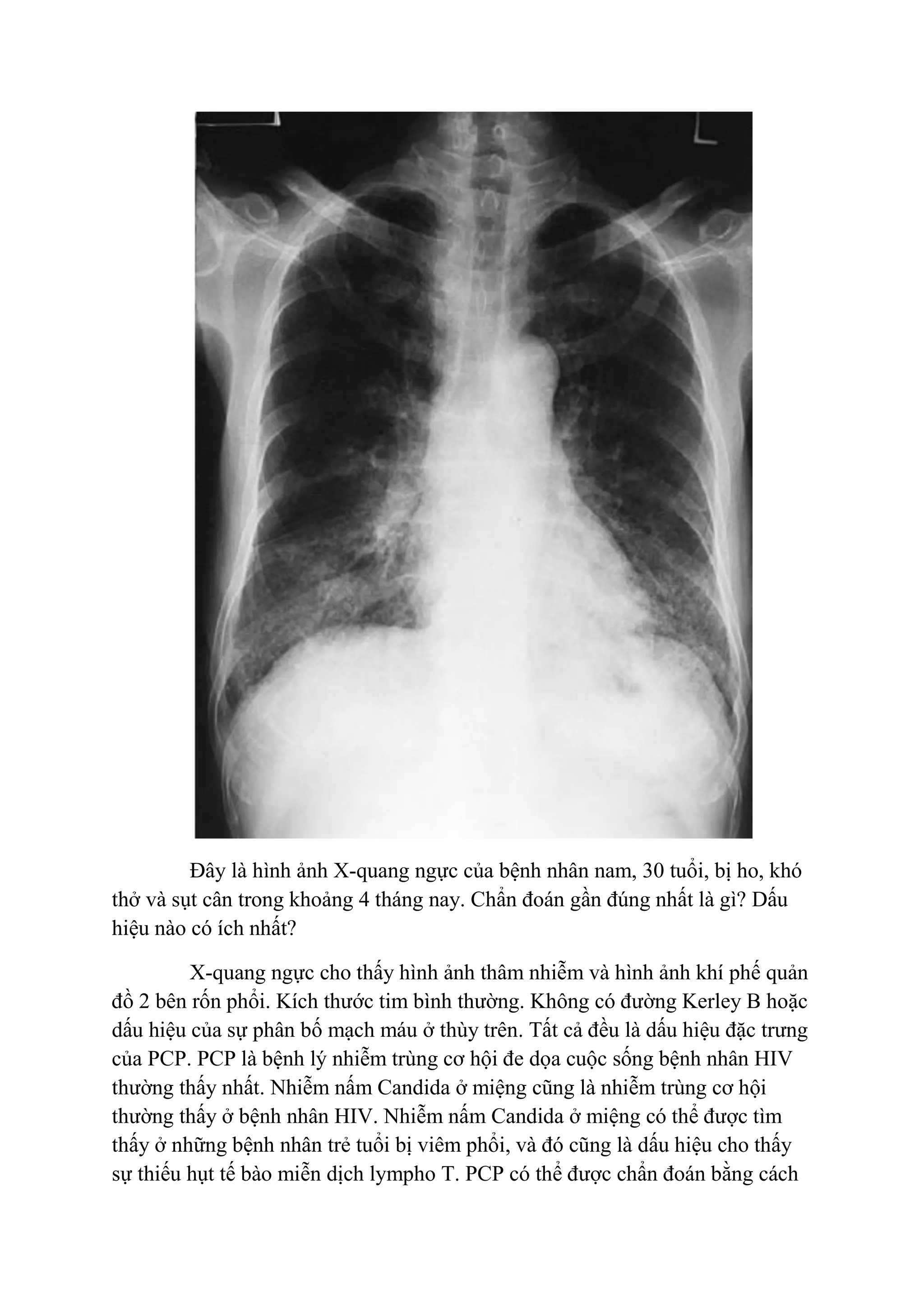 X-QUANG | 100 Case chest X rays | Chuyển ngữ tiếng Việt | PDF