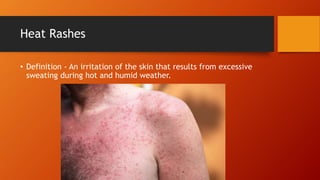 Heat Related Illnesses | PPTX