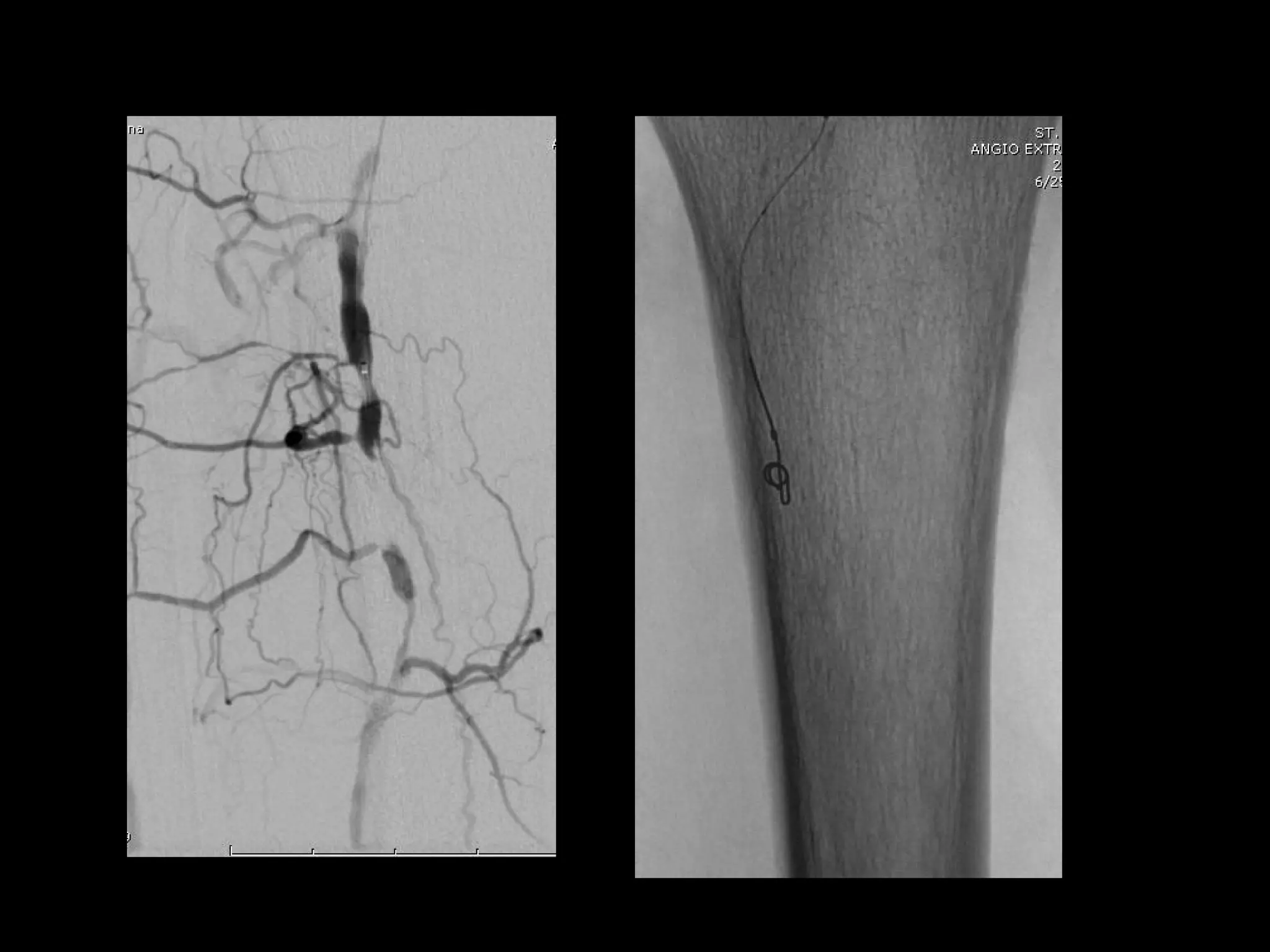 BELOW KNEE INTERVENTIONS | PPT