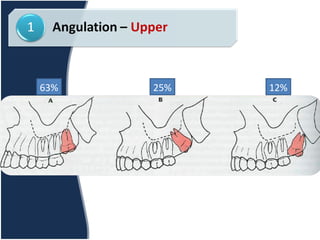 Complicated Extraction and Odontectomy | PPT