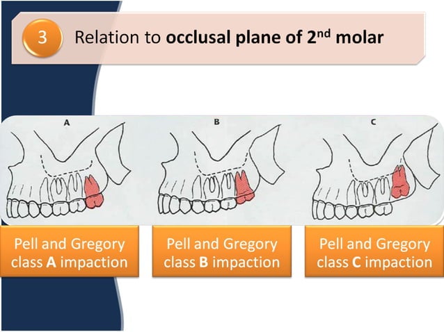Complicated Extraction and Odontectomy | PPT | Dental Health | Diseases ...