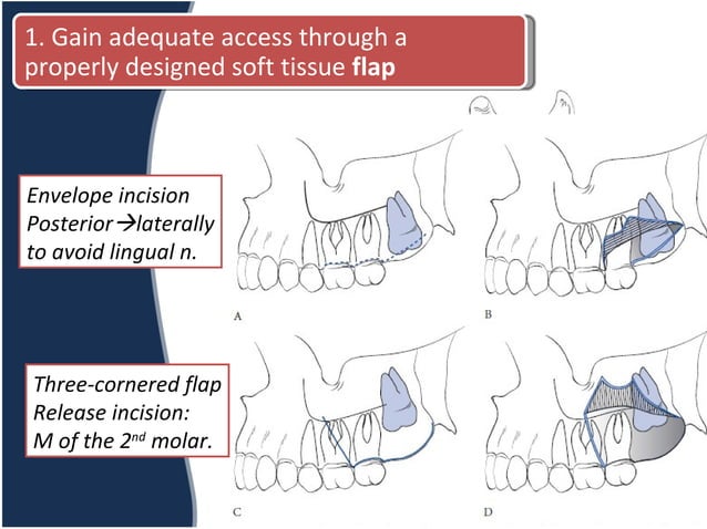 Complicated Extraction and Odontectomy | PPT | Dental Health | Diseases ...