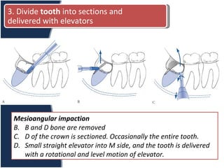 Complicated Extraction and Odontectomy | PPT