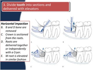 Complicated Extraction and Odontectomy | PPT