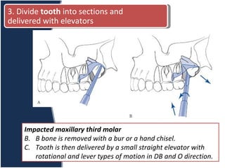 Complicated Extraction and Odontectomy | PPT