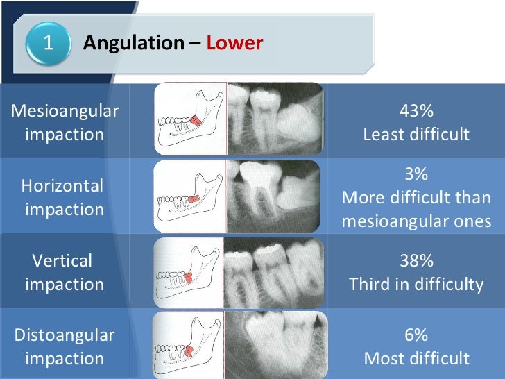 Complicated Extraction and Odontectomy