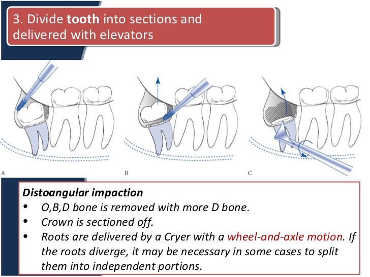 Complicated Extraction and Odontectomy