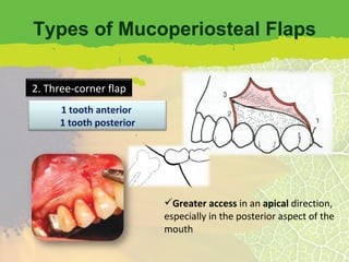 Flap Design for Minor Oral Surgery | PPT