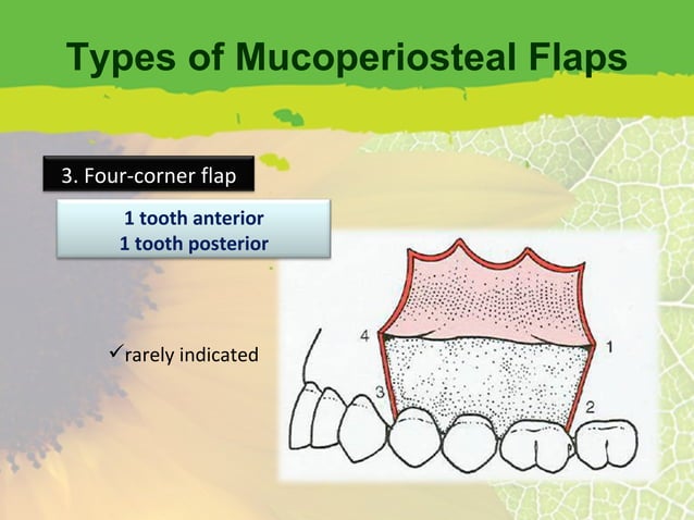 Flap Design for Minor Oral Surgery | PPT