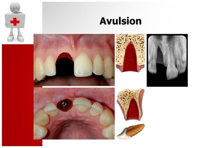 Traumatic Dental Injury and Treatment | PPT | Death, Injury, or ...