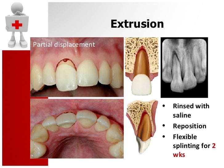 Orthodontic Extrusion Periodontal Considerations And Applications at ...