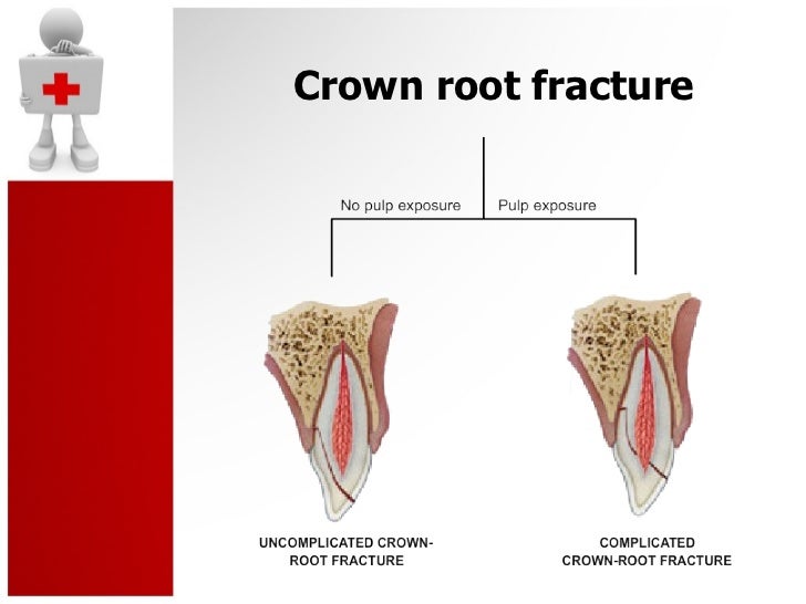 Traumatic Dental Injury and Treatment
