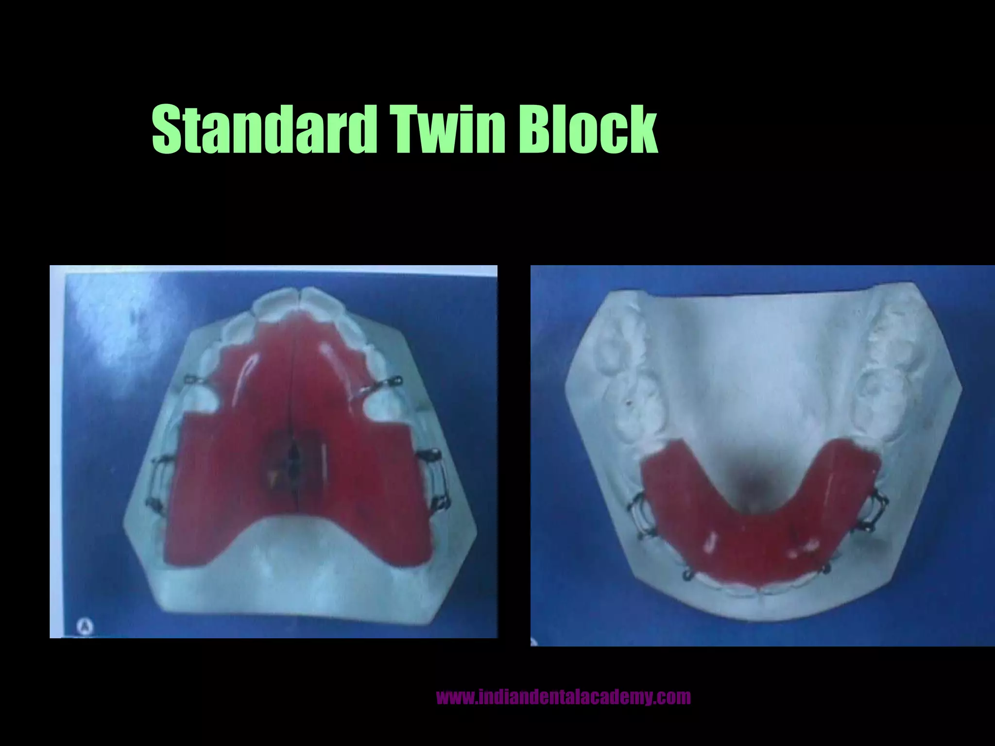 Twin block | PPT
