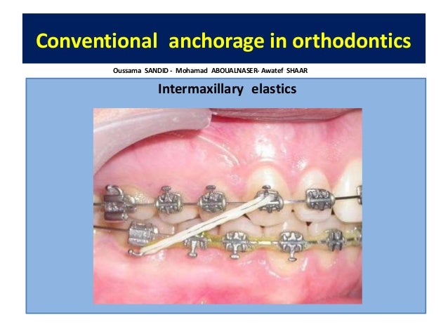 103 anchorage in orthodontics-mohamad aboualnaser-awatef shaar-oussam…