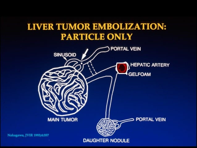 HCC EMBOLIZATION | PPT