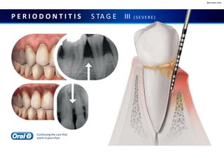 OralB_Patient_Guide_Flipchart final.pdf