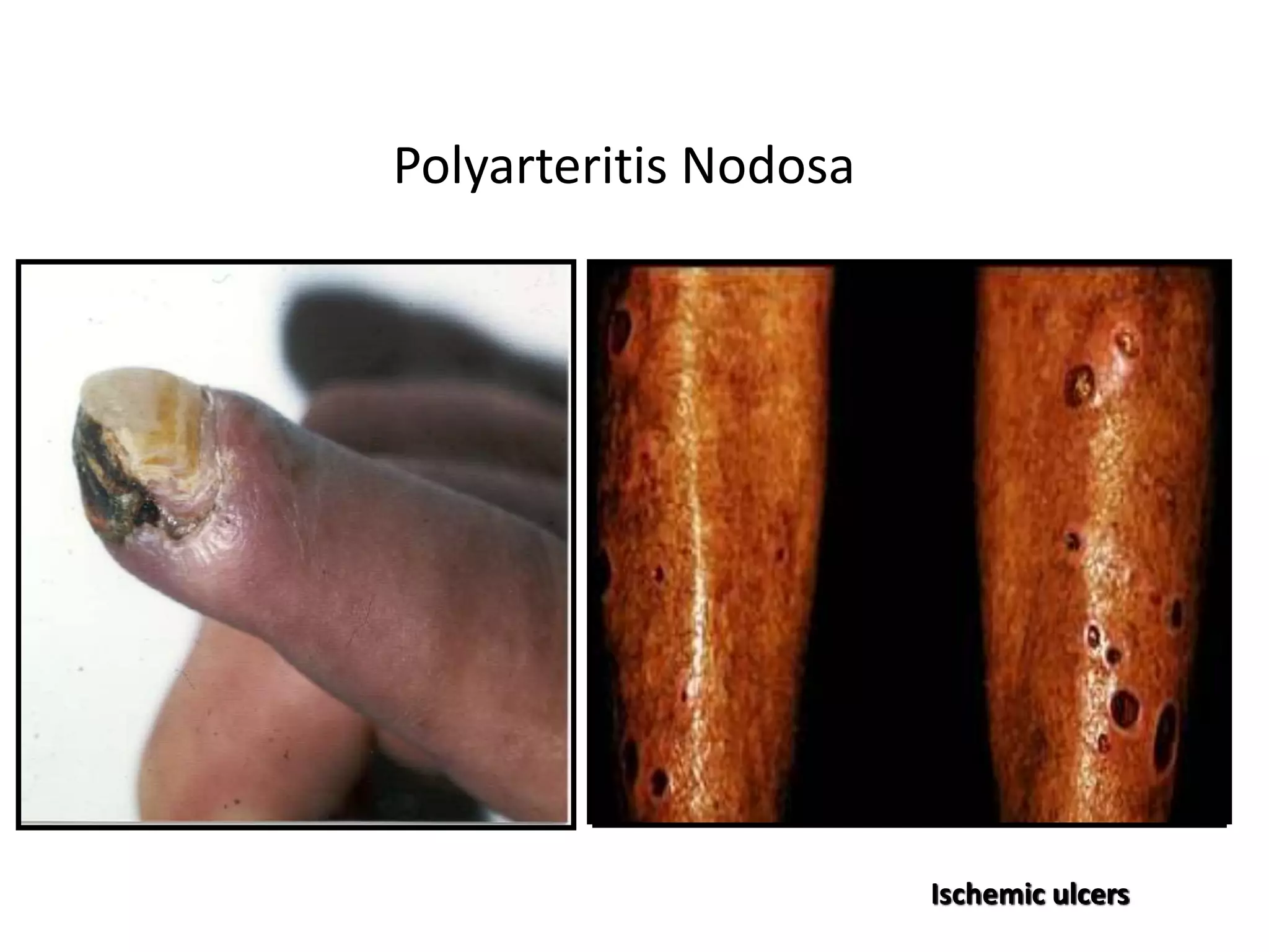 Polyarteritis nodosa | PPTX
