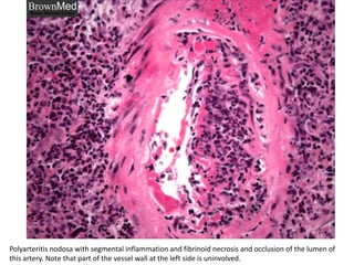 Fibrinoid Necrosis Polyarteritis Nodosa
