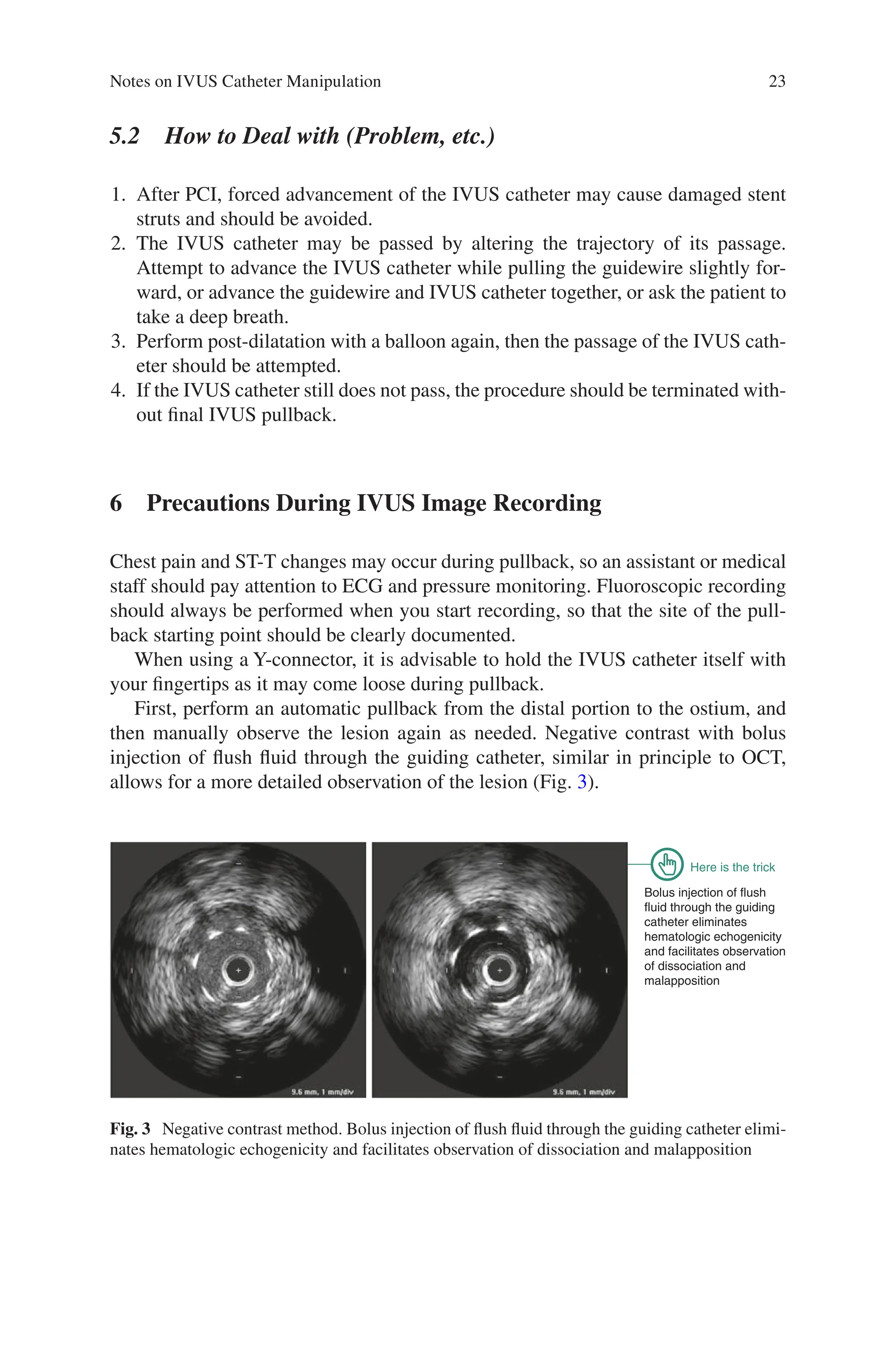 Basics of Comprehensive IVUS Guided PCI Junko Honye (Editor) | PDF