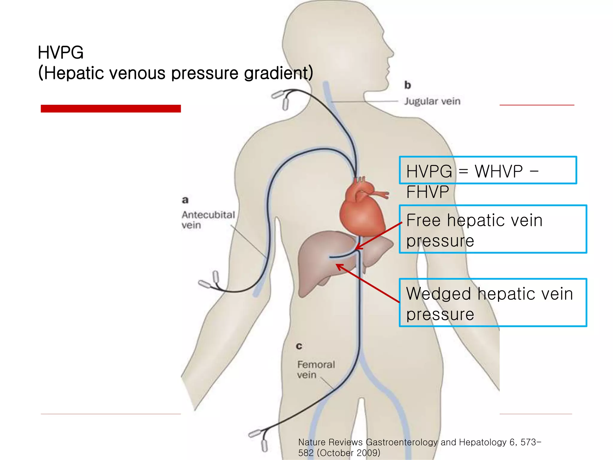 Varices esofagicas | PPT