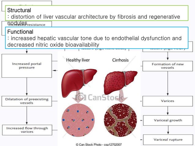 Varices esofagicas | PPT | Digestive Disorders | Diseases and Conditions