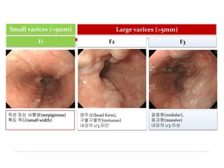 Varices esofagicas | PPT