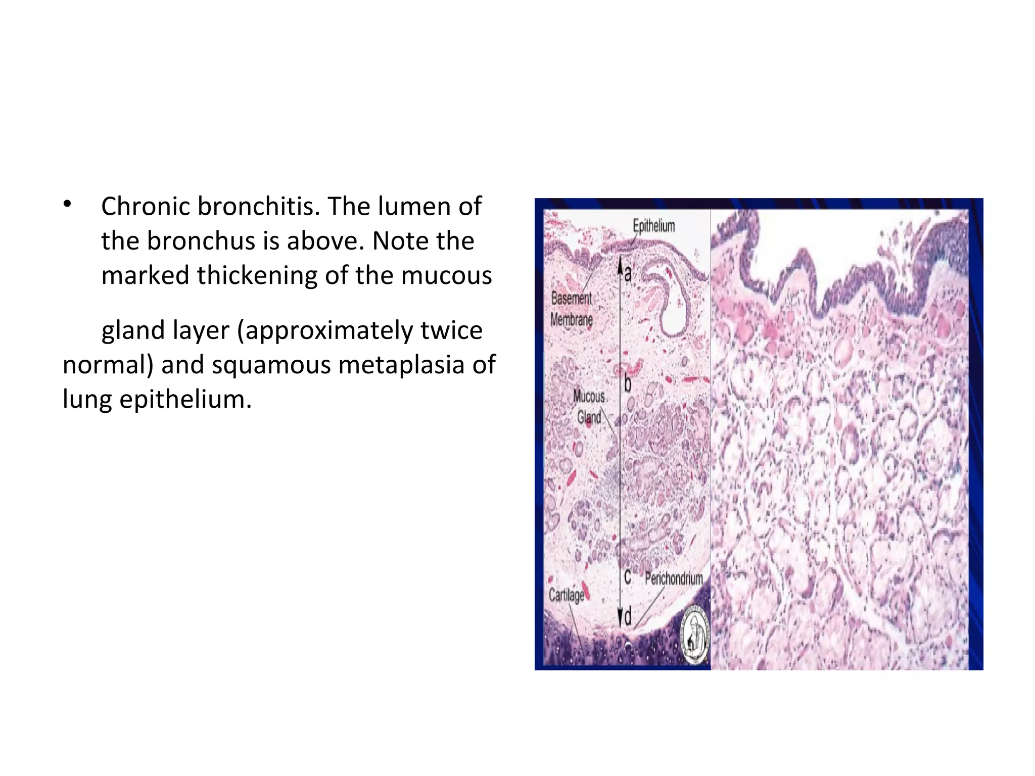 CHRONIC OBSTRUCTIVE PULMONARY DISEASES (COPD) | PPT