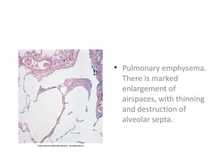 Emphysema Histology Labeled