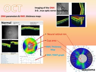 primary open angle glaucoma by Hala Fathi Hannot | PPTX
