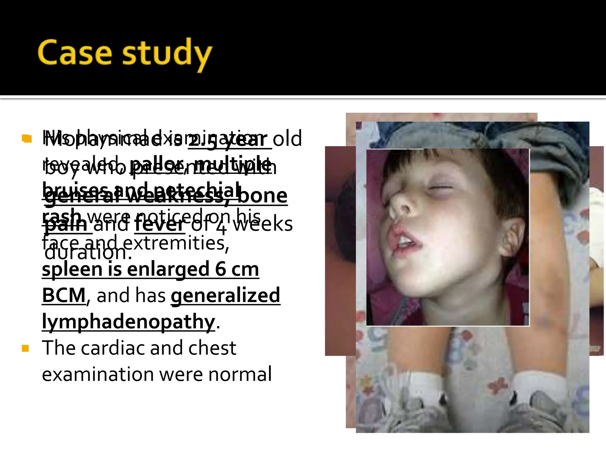 Acute Lymphoblastic Leukemia in Children.ppt