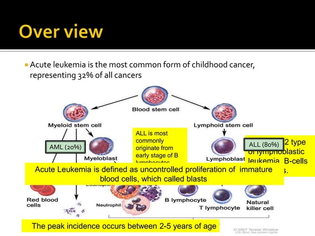 Acute Lymphoblastic Leukemia in Children.ppt